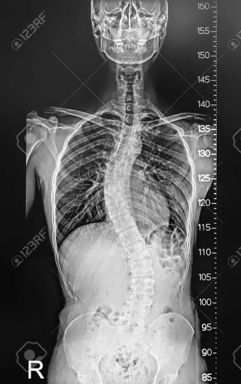 scoliose radiographie | Lombafit