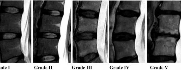 Discopathie dégénérative: Le guide complet | Lombafit