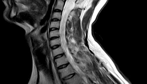 IRM cervical : Tout savoir sur cette imagerie | Lombafit