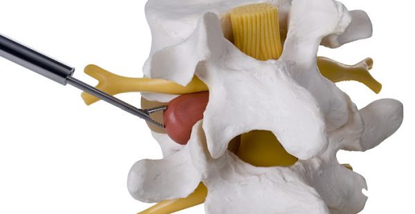 Microdiscectomie: Chirurgie pour hernie discale (Indications)
