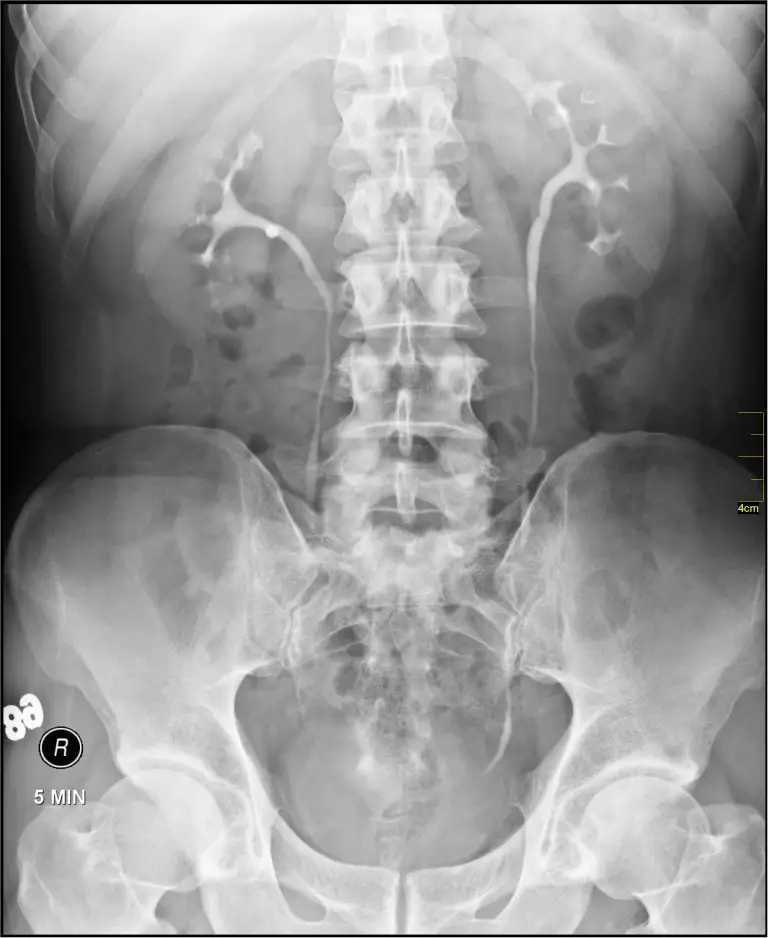 Infiltration lombaire sous scanner : Procédure et risques | Le mal de ...