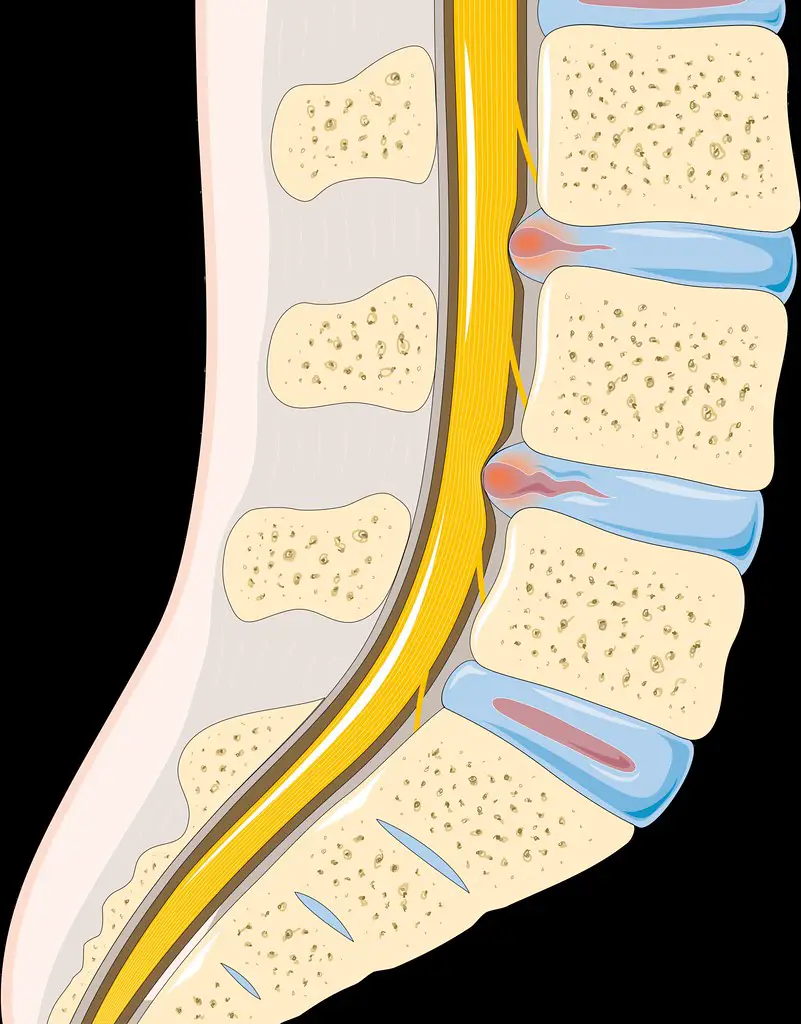 Sténose spinale sévère : Que faire ? (Faut-il s'inquiéter ?) |