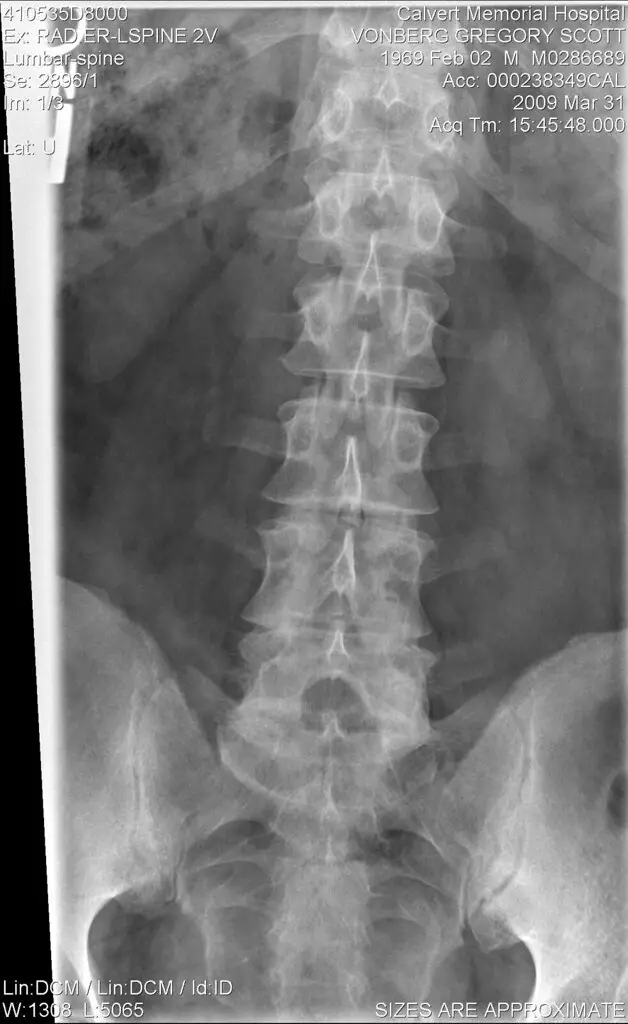 Discopathie dégénérative L5-S1: Que faire ? (guide complet) | Lombafit
